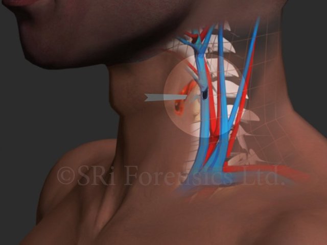 SRi Forensics Ltd. - 3D Injury Depiction